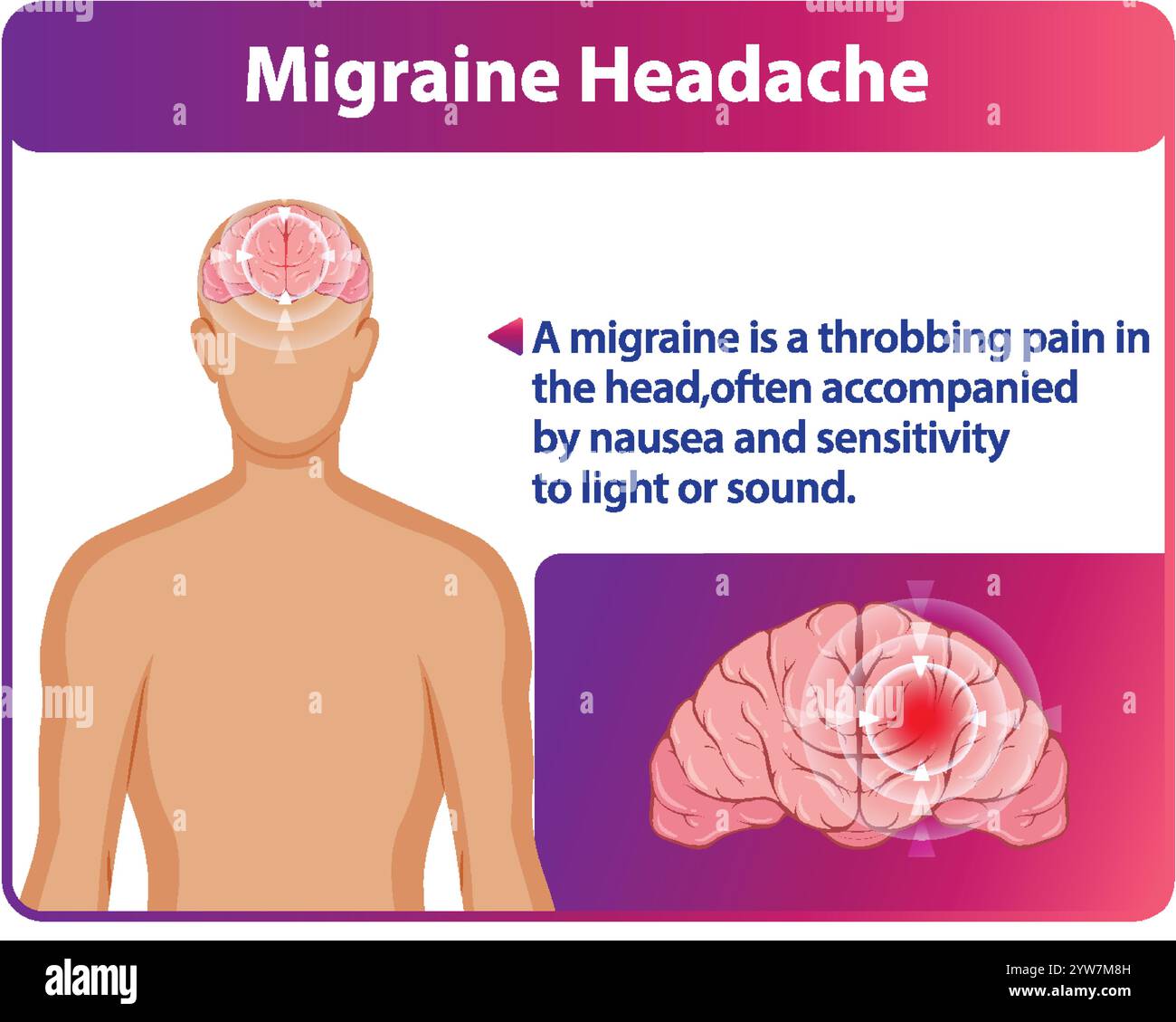 Illustration of migraine pain and symptoms explanation Stock Vector ...