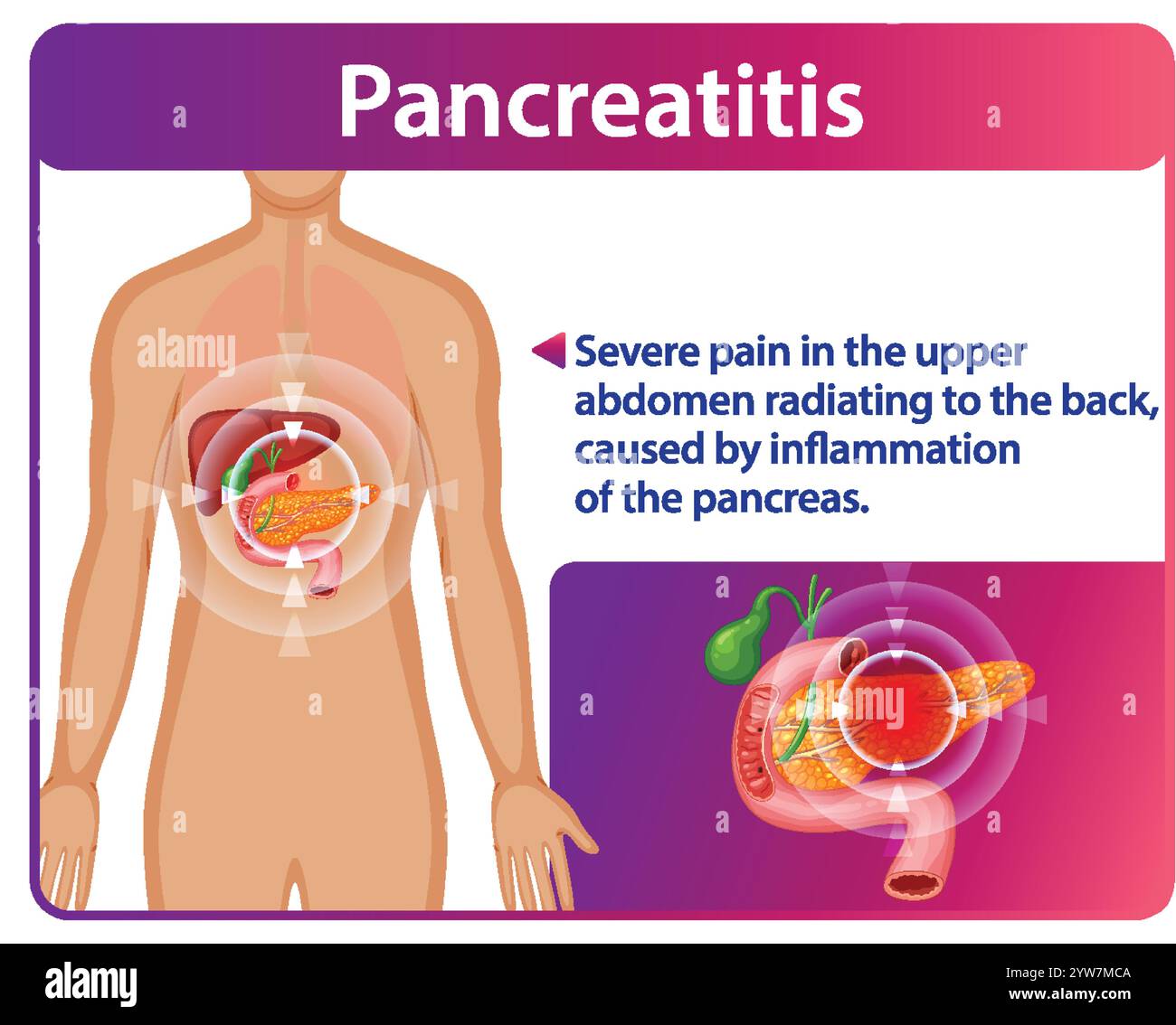 Illustration of pancreatitis symptoms and affected organs Stock Vector ...