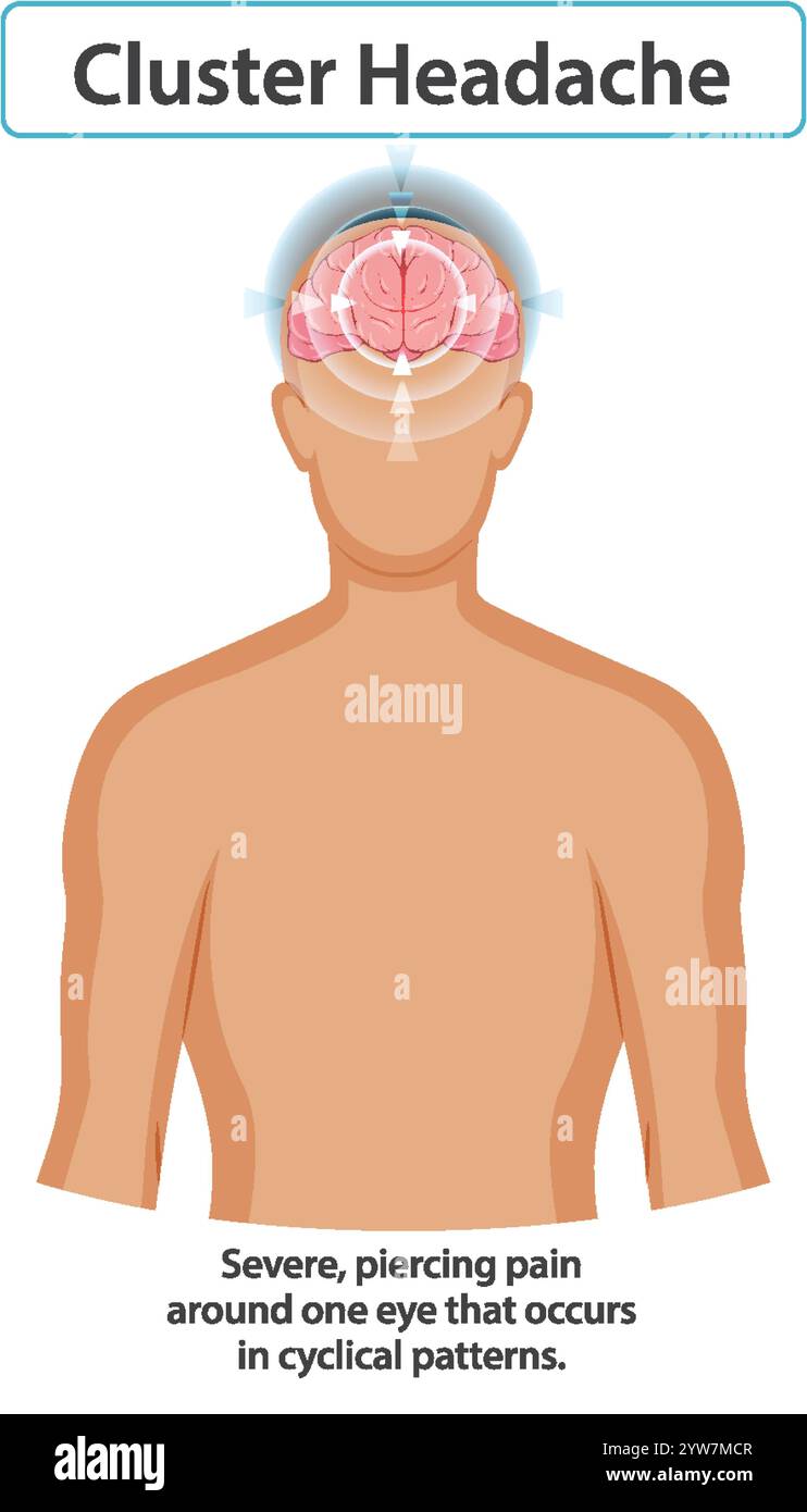 Illustration of cluster headache pain and location Stock Vector Image ...