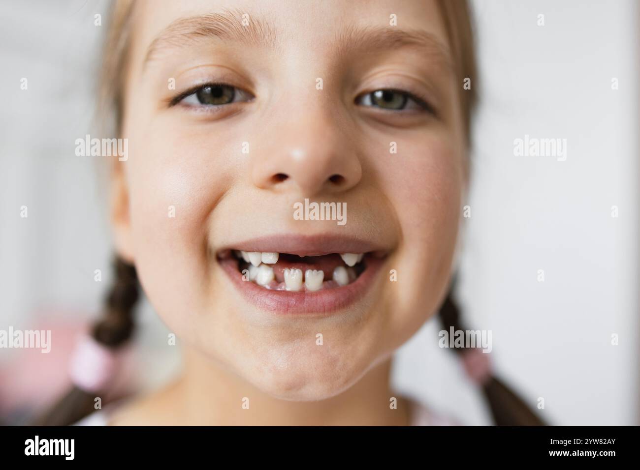 Portrait of young Caucasian girl with missing teeth from falling out ...