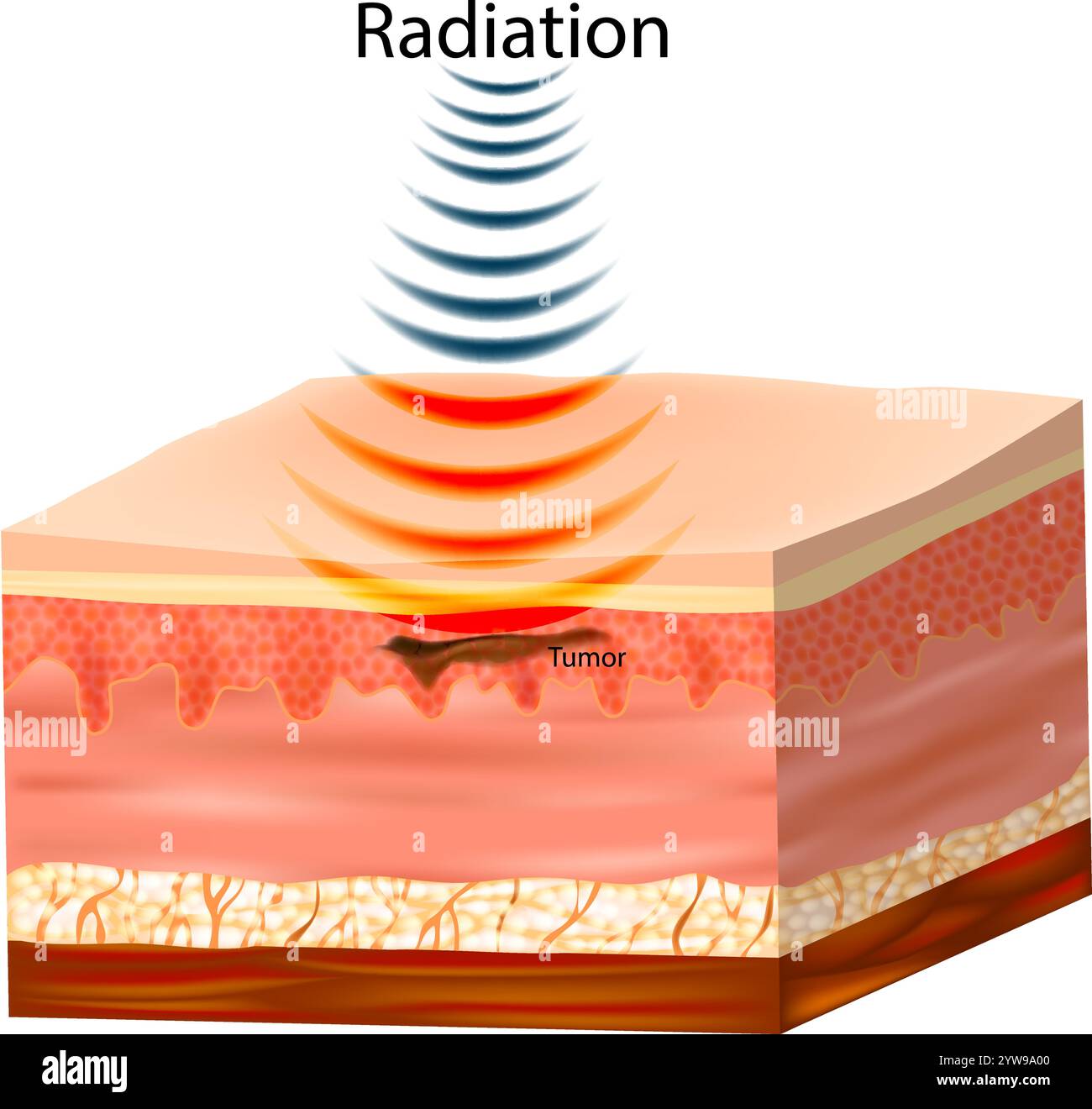 Radiation therapy or radiotherapy. Cancer treatment that uses high ...