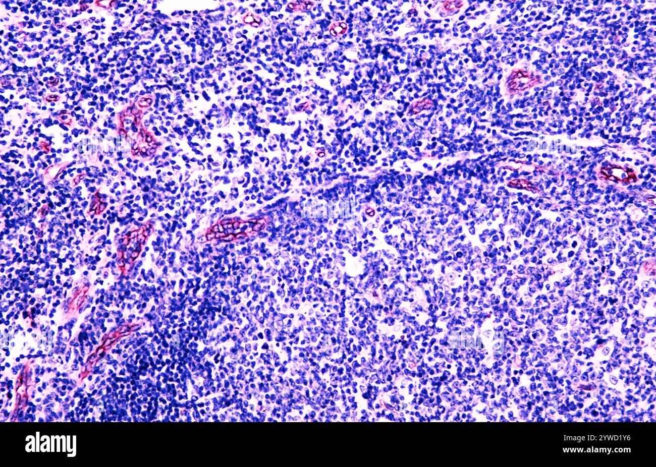 Human palatine tonsil, light micrograph. It is stained with an immunohistochemical method for ...