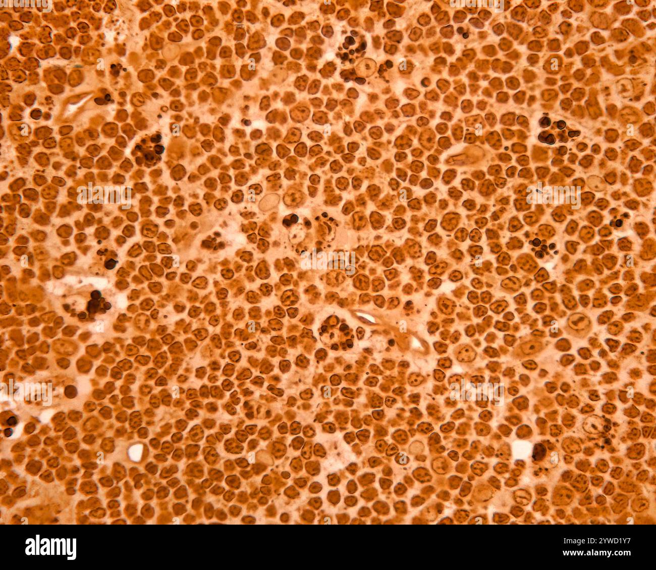 Lymph node. Light micrograph showing large macrophages full of ...