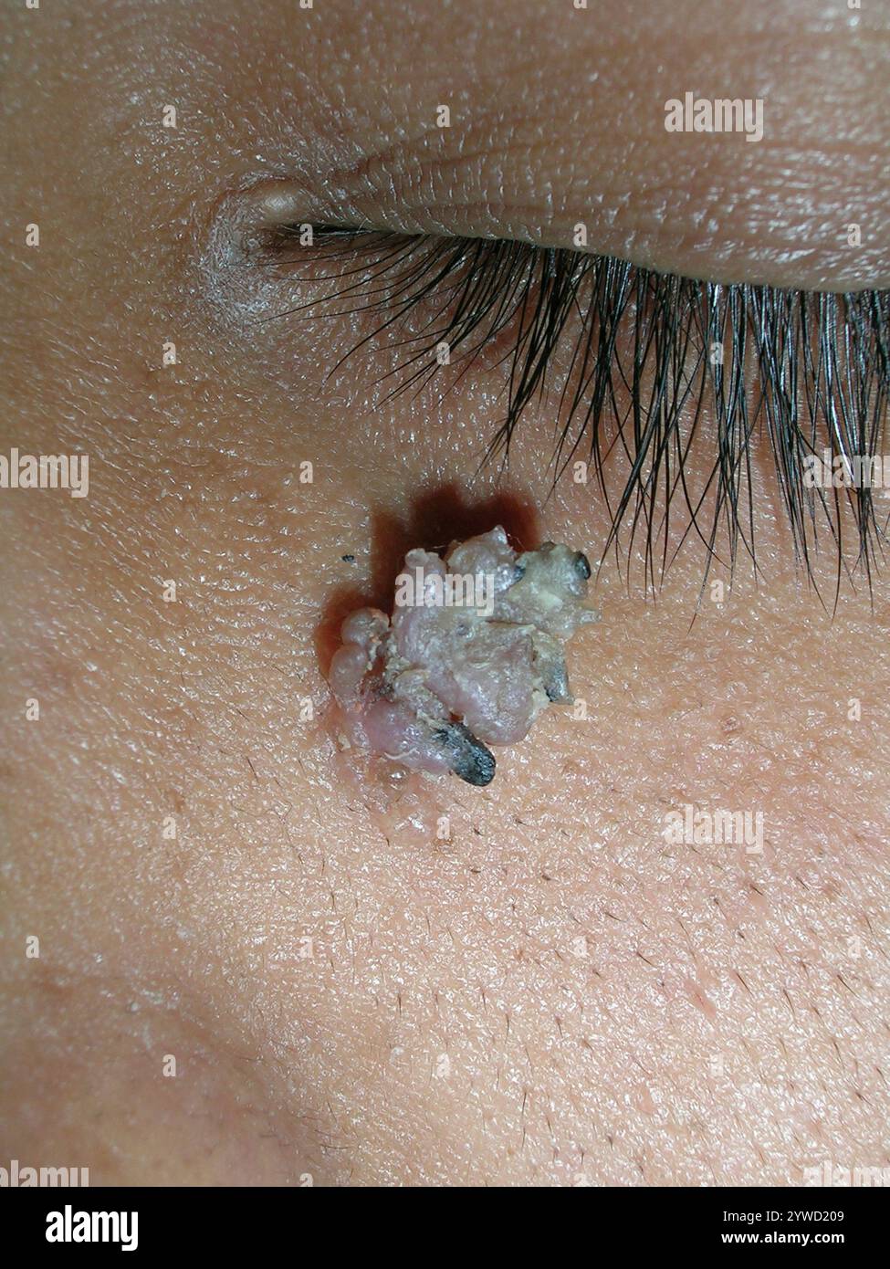 Wart on a patient's face. Warts, are harmless but contagious growths of ...