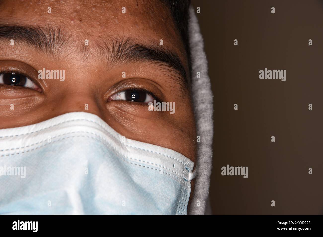 Skin tag on a patient's lower eyelid. A skin tag (acrochordon) is a ...