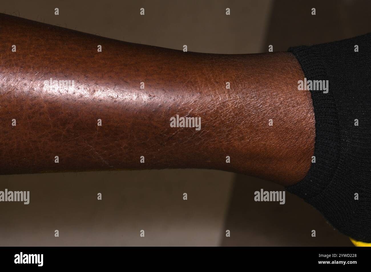 Ichthyosis on an 18 year old African-American female patient's ankle ...