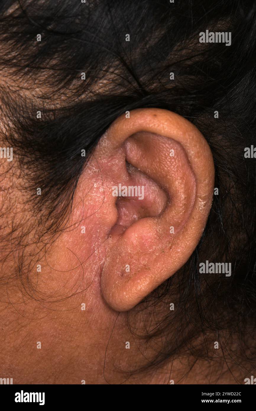 Atopic dermatitis on the ear of a female Hispanic patient. Atopic ...