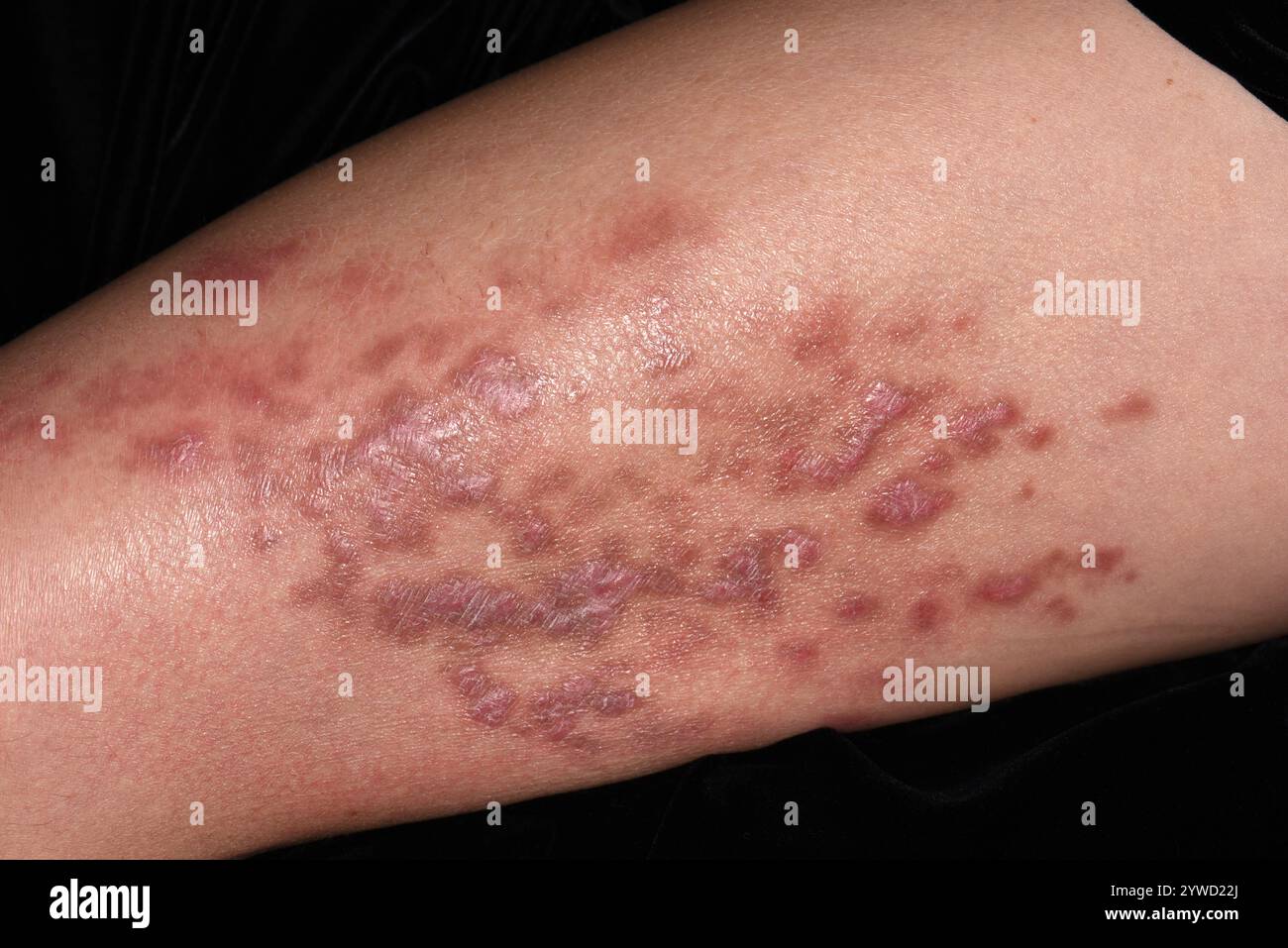 Lichen planus on a patient's leg. Lichen planus is an inflammatory ...