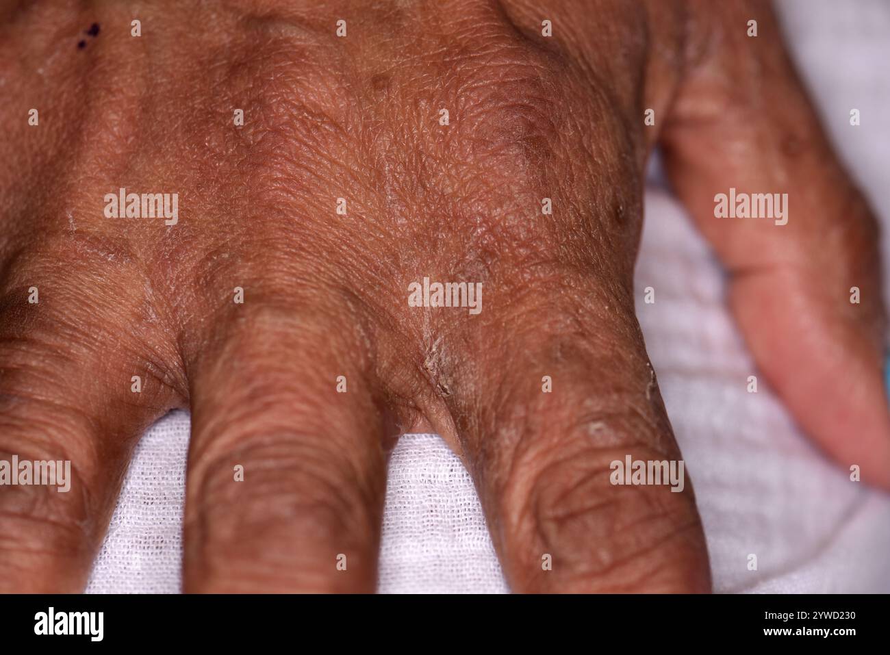 Hand of a 62 year old Hispanic female patient infected with scabies ...