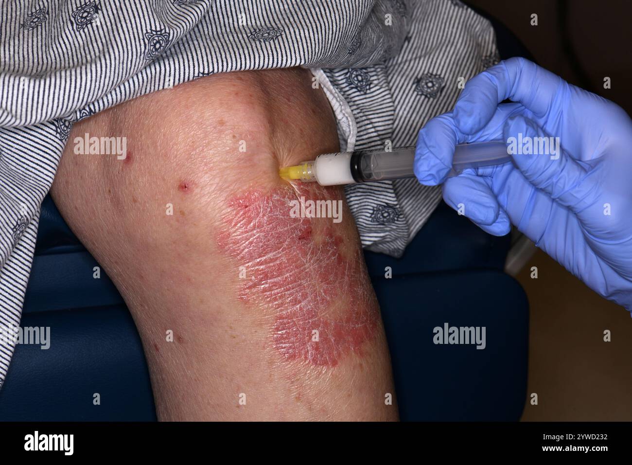 Doctor administering an intralesional injection of an anti-inflammatory ...