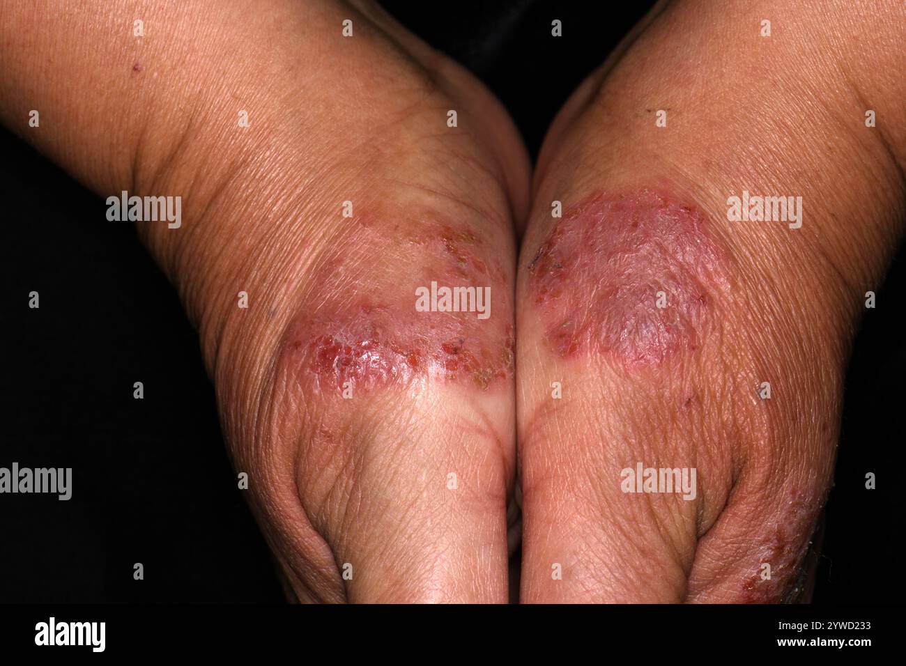 Nummular eczema on a Hispanic female patient's hands. Eczema is an ...