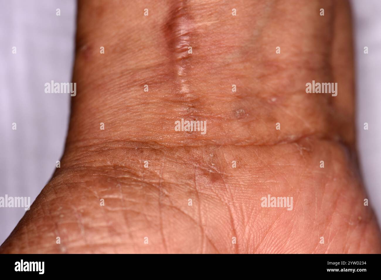 Wrist of a 62 year old Hispanic female patient infected with scabies ...