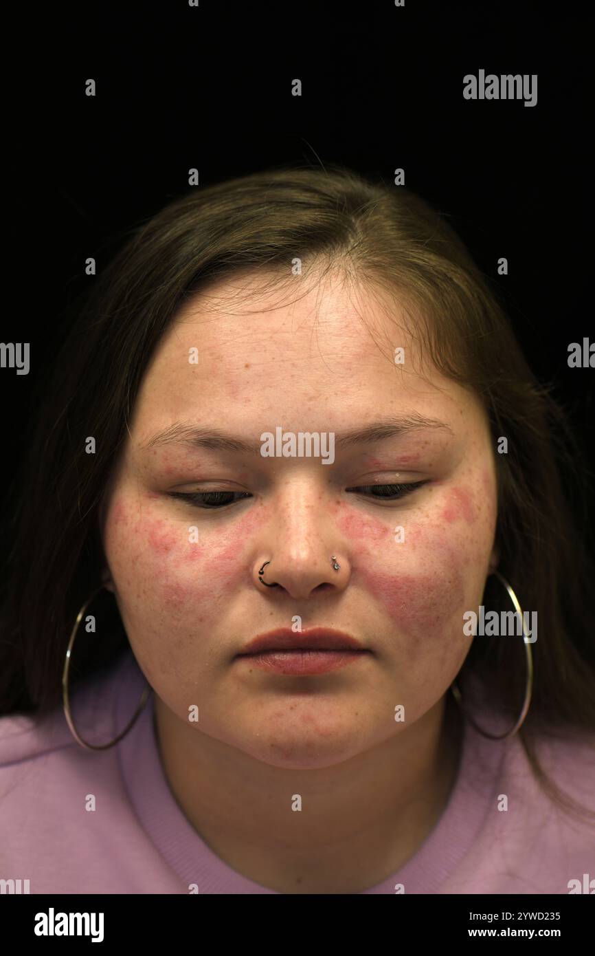 Redness on the face of a 23 year old Hispanic female patient with ...