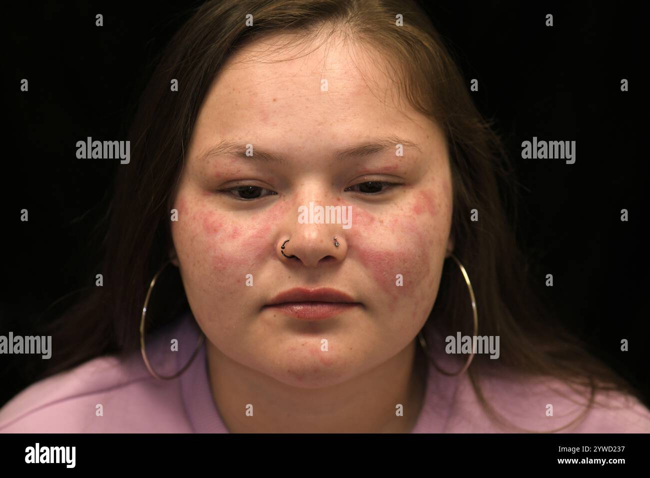 Redness on the face of a 23 year old Hispanic female patient with ...