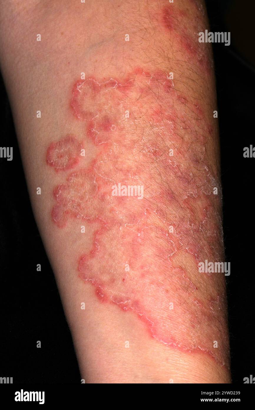 Ringworm infection on a patient's skin. Ringworm is a disease caused by ...