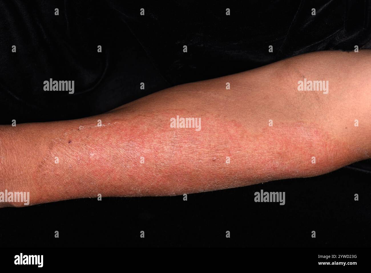 Ringworm infection on a patient's arm. Ringworm is a disease caused by ...