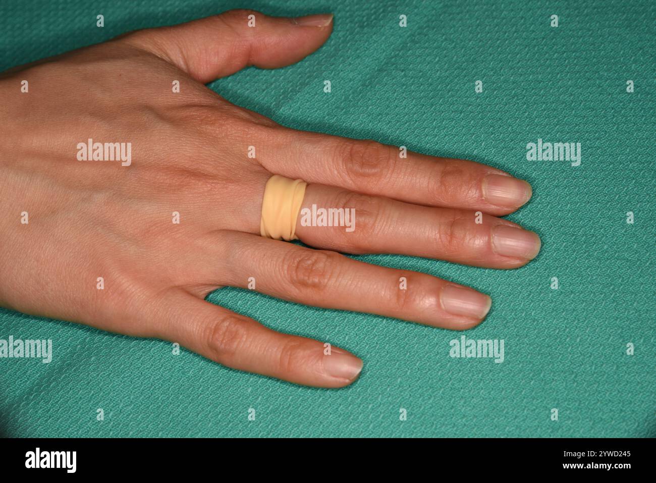 Finger cut from a rubber glove being used as a tourniquet. For other ...