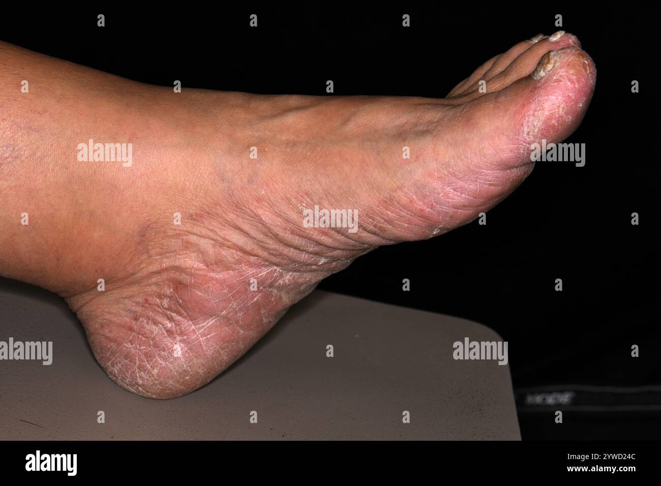 Fungal nail infection and athlete's foot. A fungal nail infection is ...