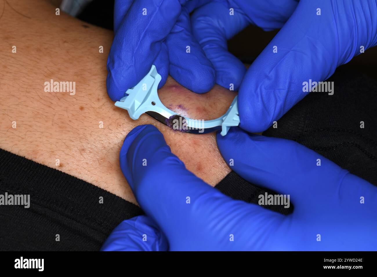 Doctor taking a shave biopsy of a lesion on a patient's shoulder. For ...