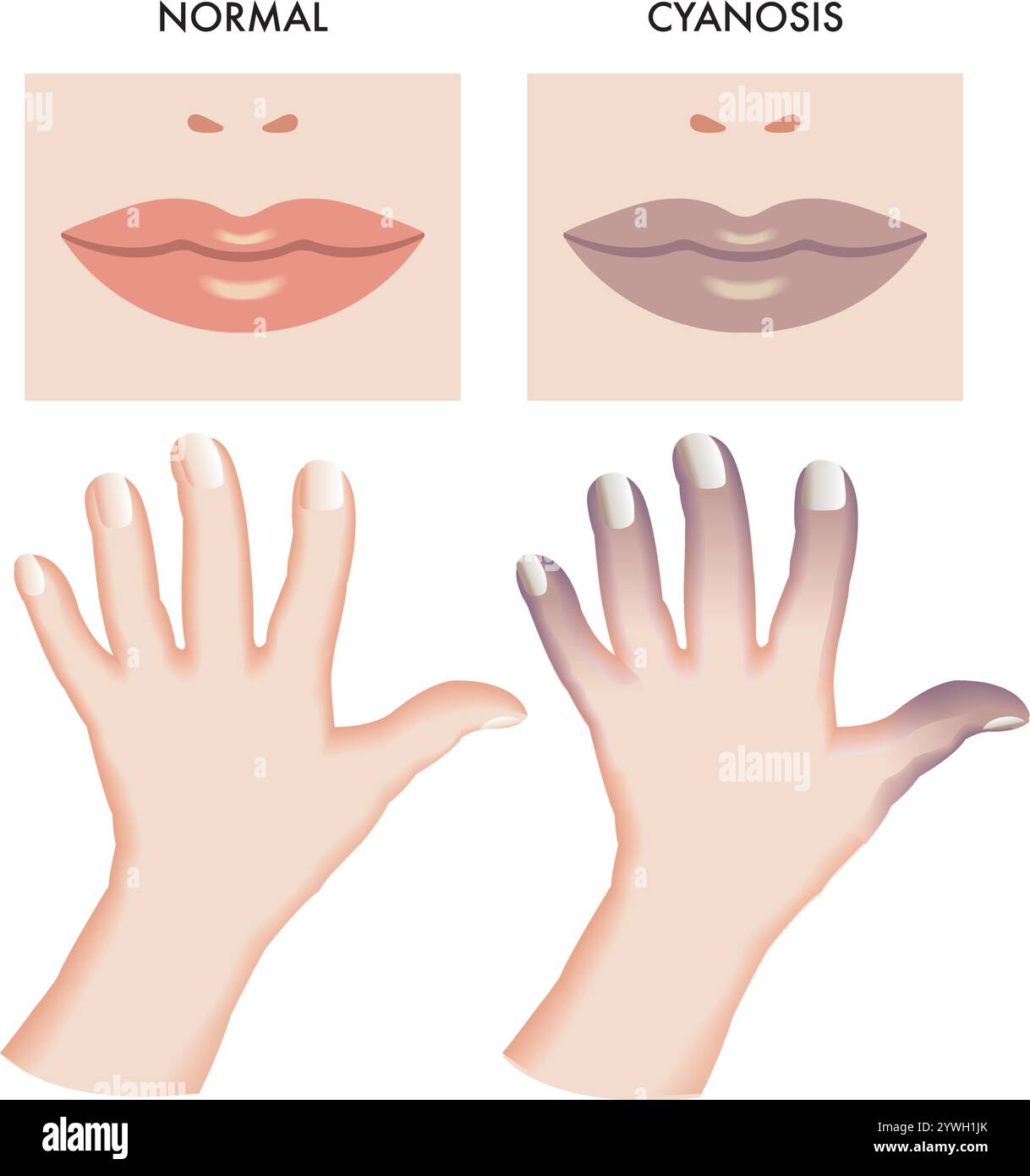 Medical illustration of symptoms of cyanosis Stock Vector Image & Art ...