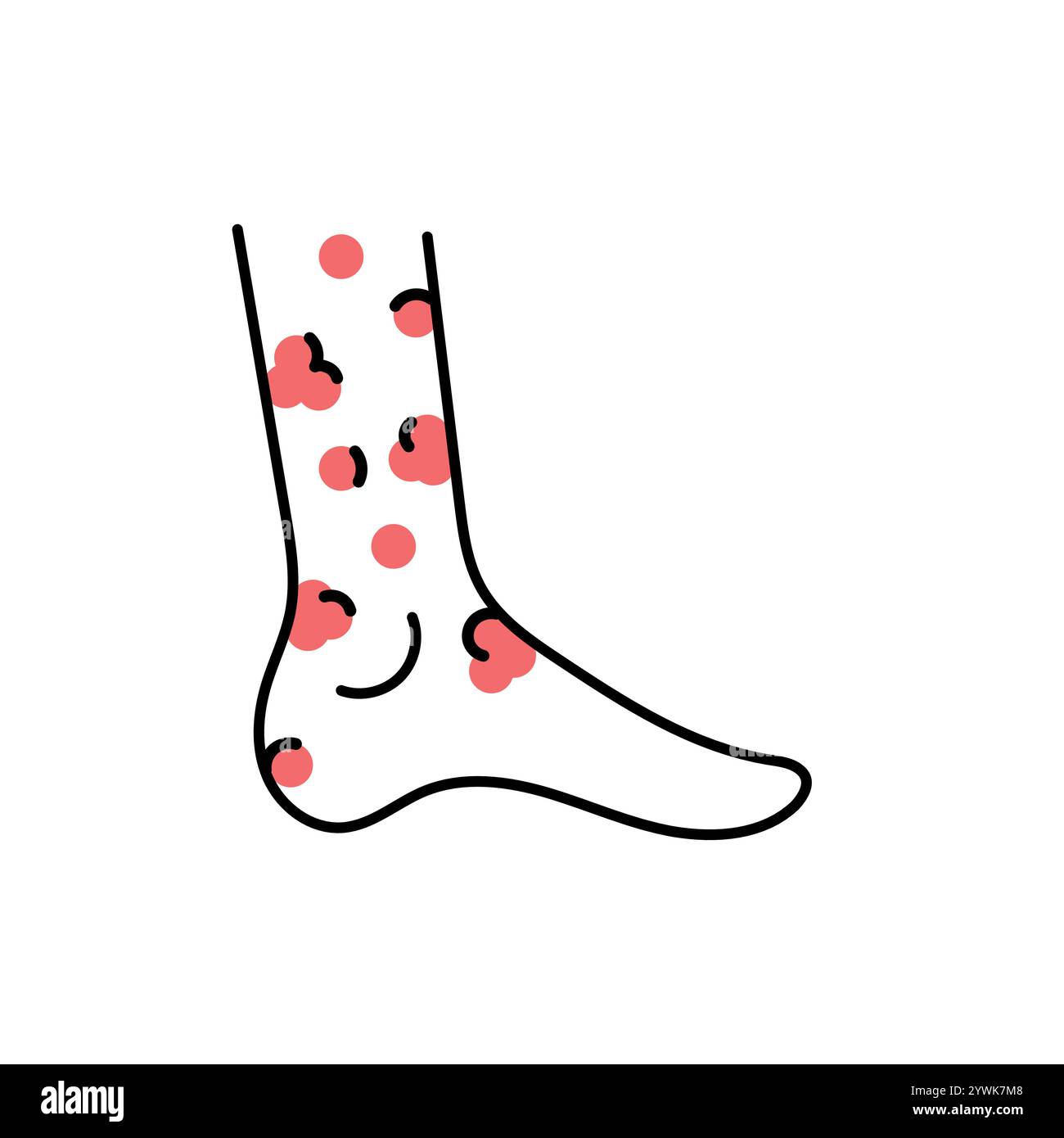 Lupus systemic erythematosus autoimmune Stock Vector Images - Alamy