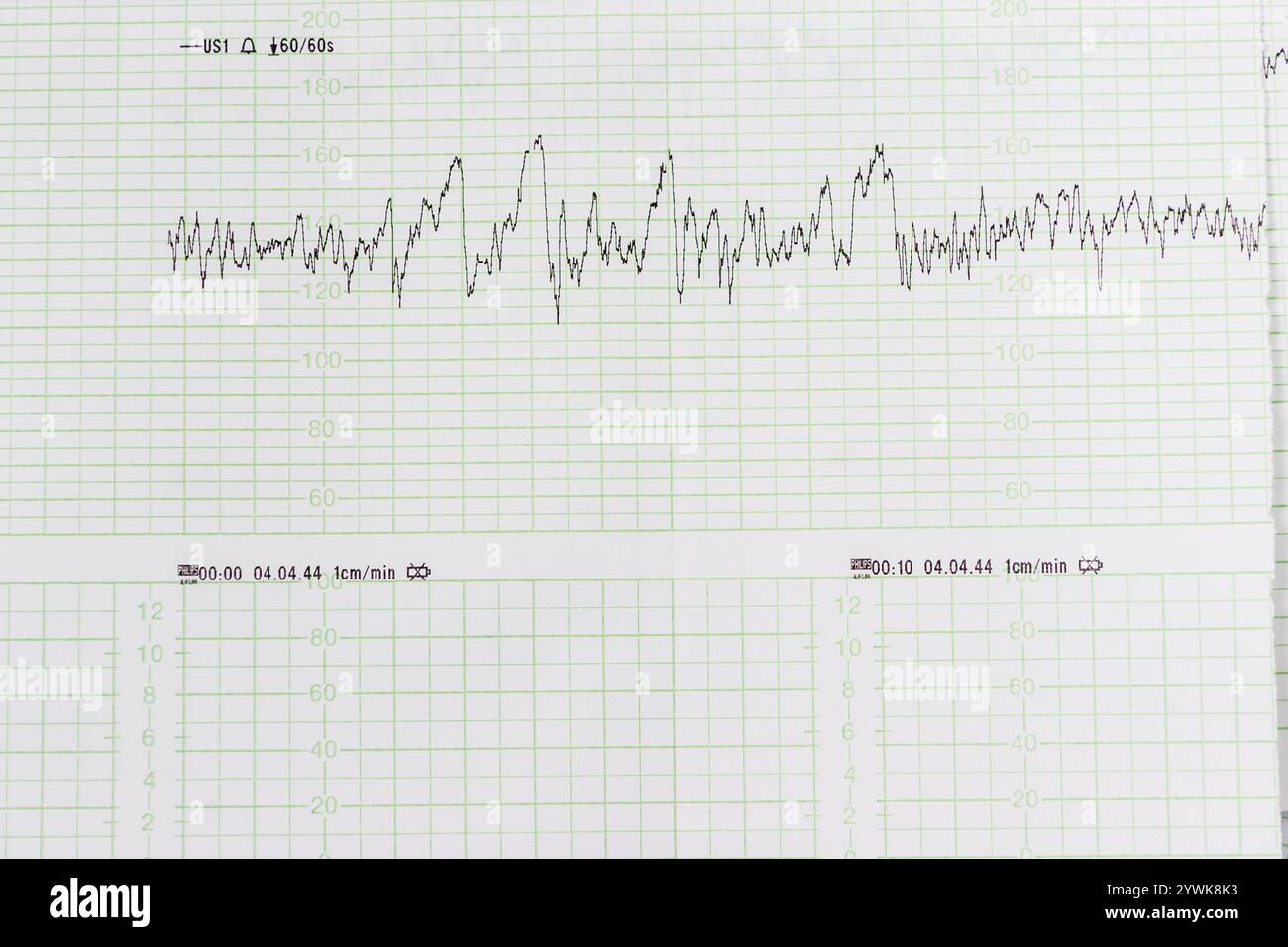 Electrocardiogram graph ekg heart rhythm hi-res stock photography and ...