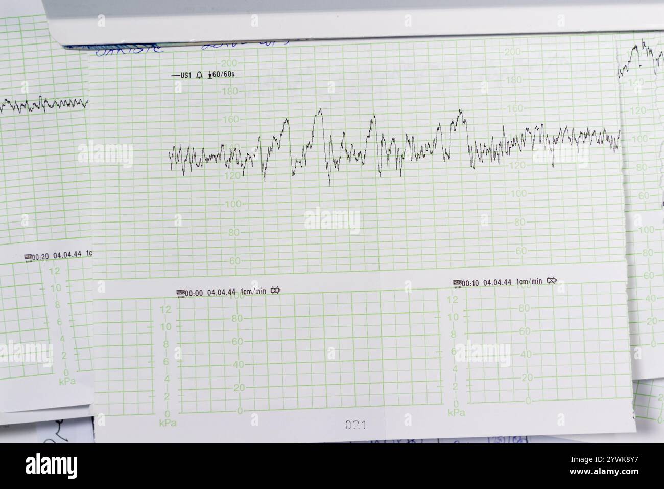 Medical findings graph. Irregular lines on the green grid Stock Photo ...