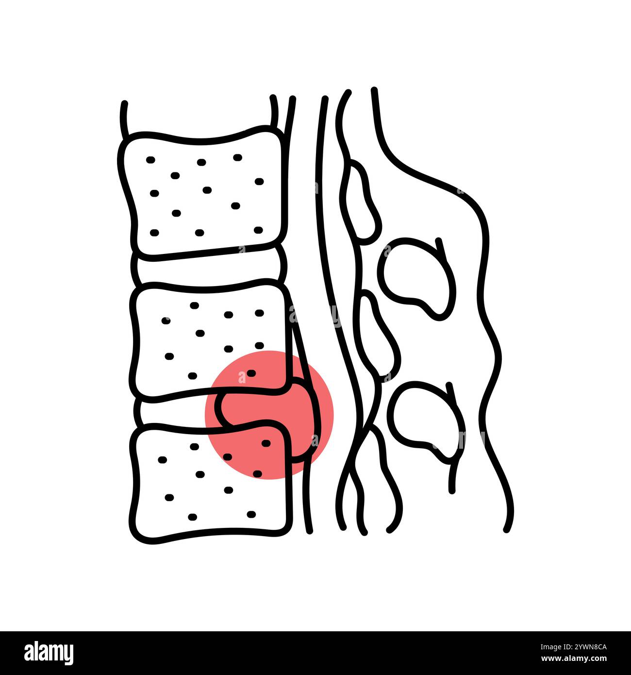 Intervertebral disc protrusion Cut Out Stock Images & Pictures - Alamy