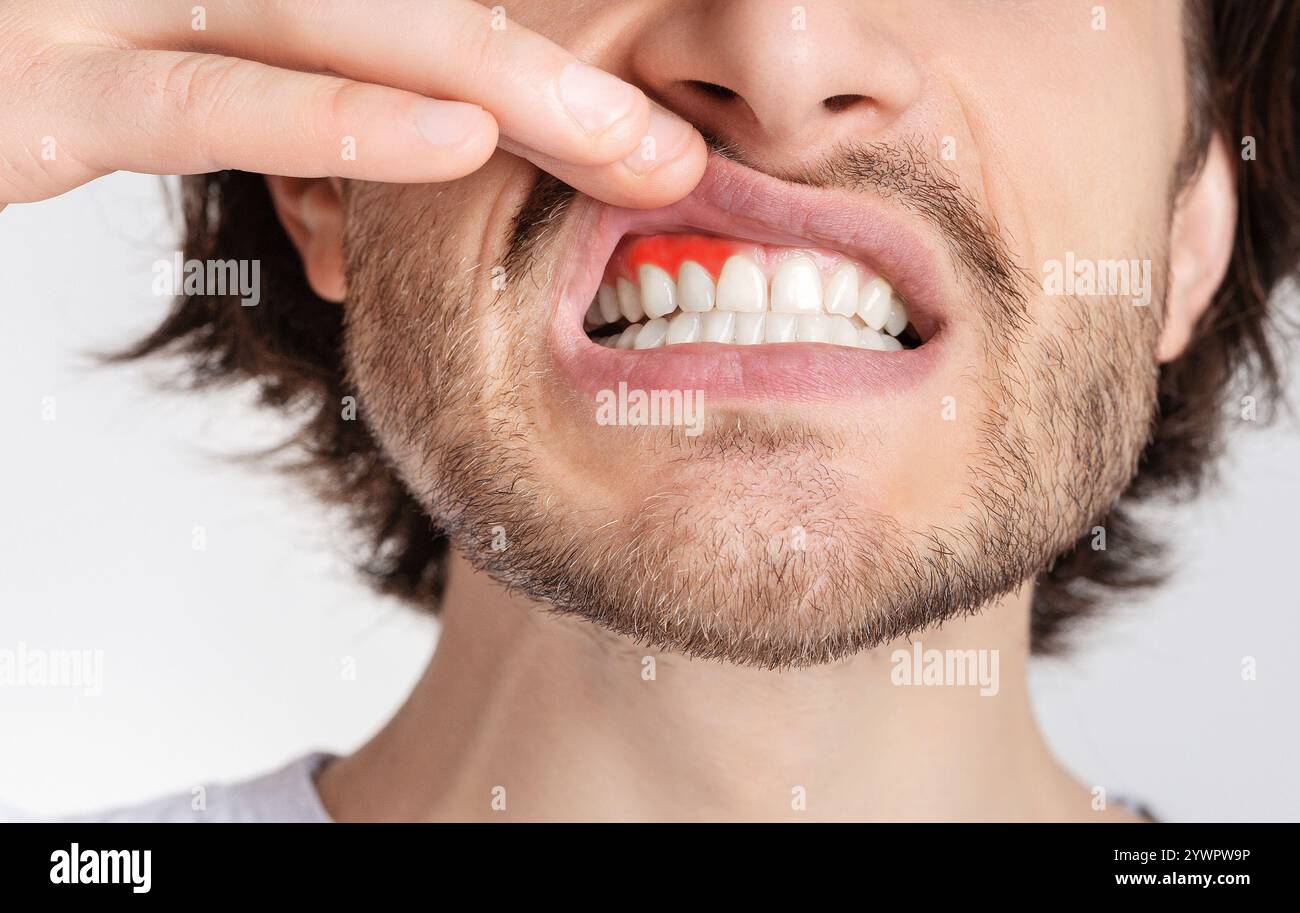 Gingival inflammation and dental problems. Guy pushes his lip up and ...