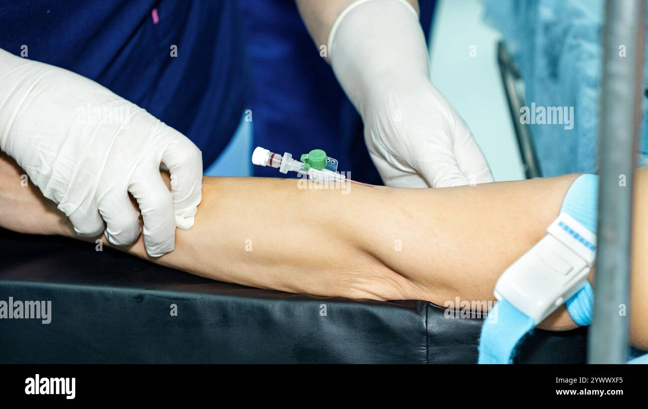 A catheter or IV needle in a patient's hand. A doctor wearing sterile ...