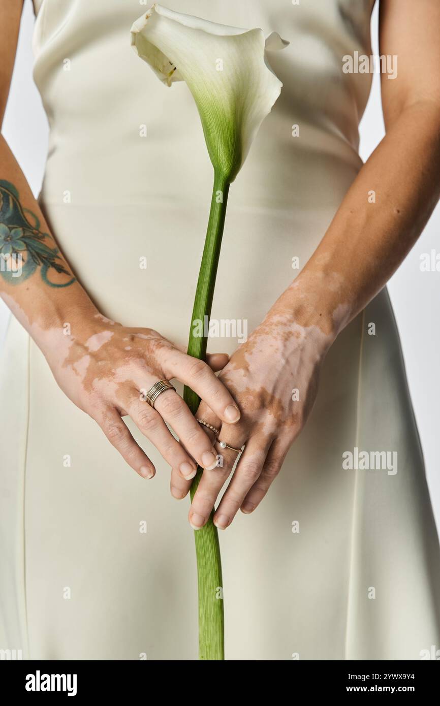 Young woman with beautiful vitiligo poses gracefully with a calla lily ...