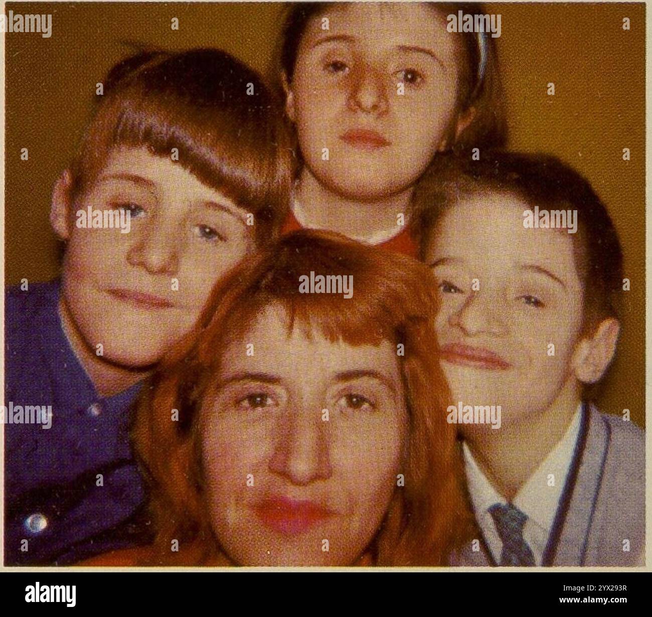 Crouzon Syndrome 4 Stock Photo - Alamy