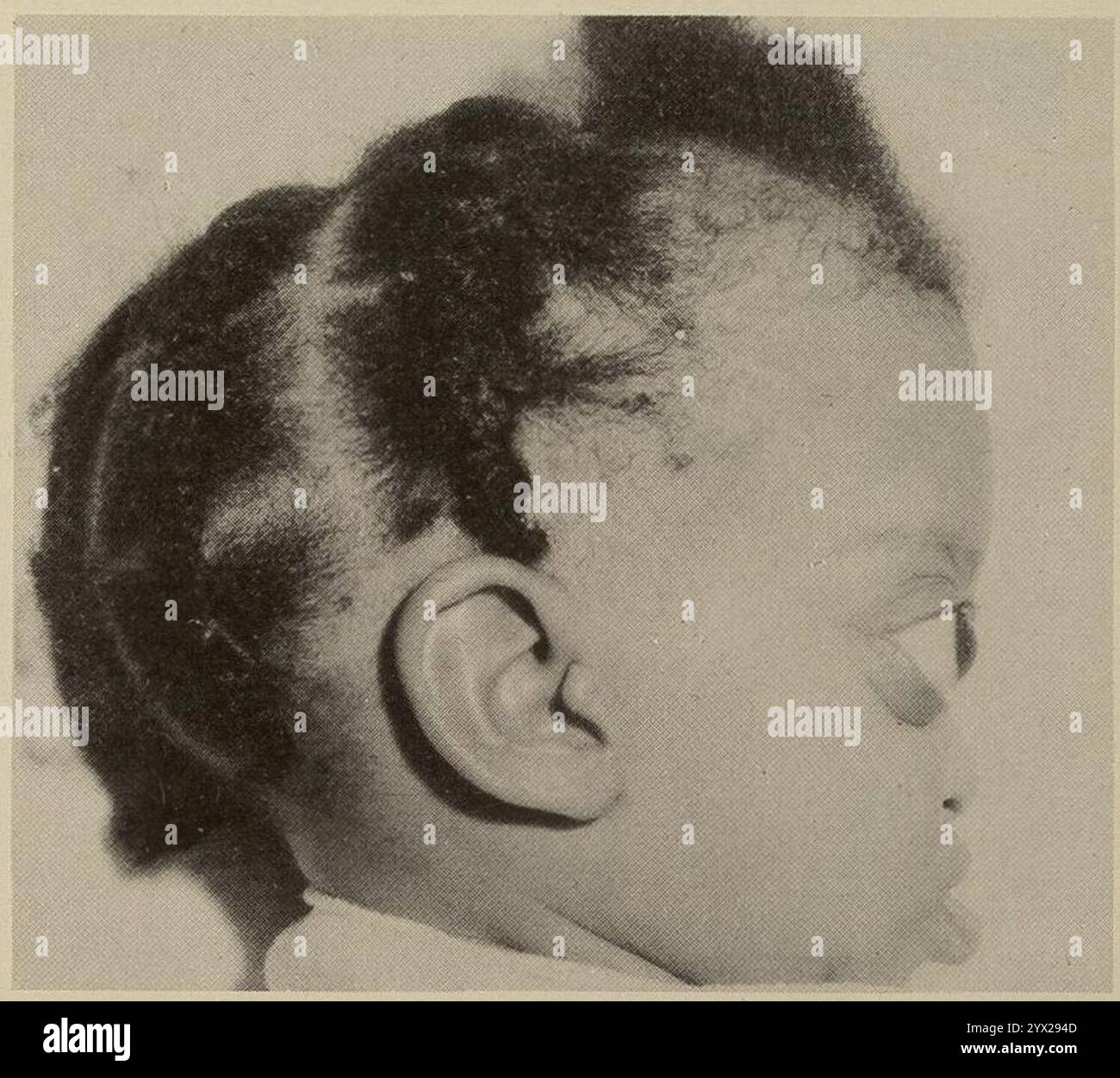 Crouzon syndrome hi-res stock photography and images - Alamy