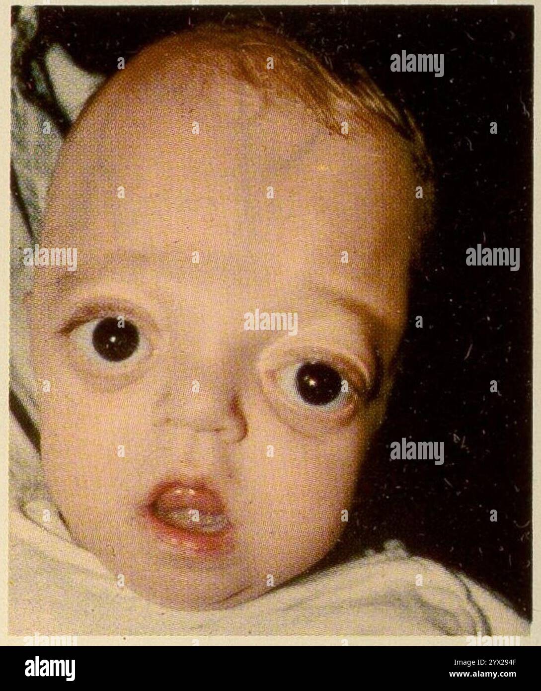 Crouzon Syndrome 1 Stock Photo - Alamy