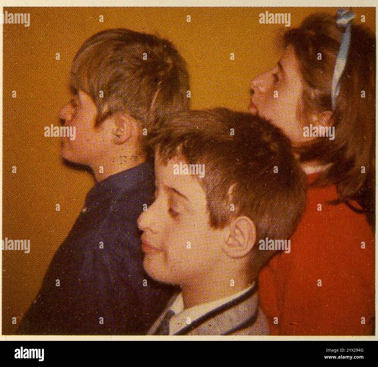 Crouzon Syndrome 3 Stock Photo - Alamy