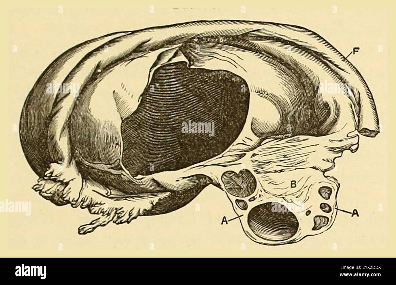Cyst of the parovarium, showing its relation to the ovary and tube ...