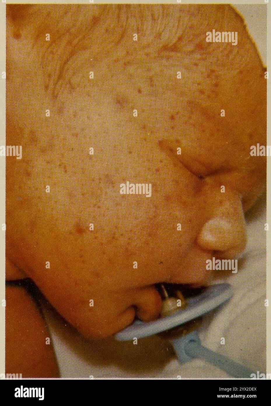 Cytomegalic Inclusion Disease (Congenital) 2 Stock Photo - Alamy