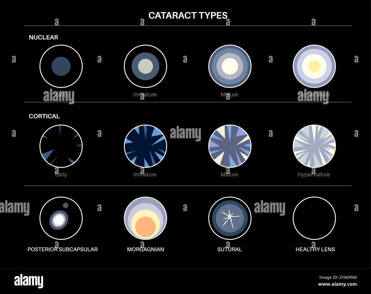 Cataract eye disease, illustration Stock Photo - Alamy