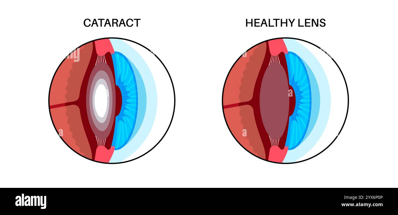 Cataract eye disease, illustration Stock Photo - Alamy