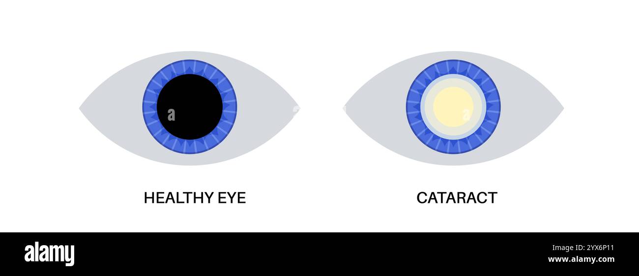 Cataract eye disease, illustration Stock Photo - Alamy