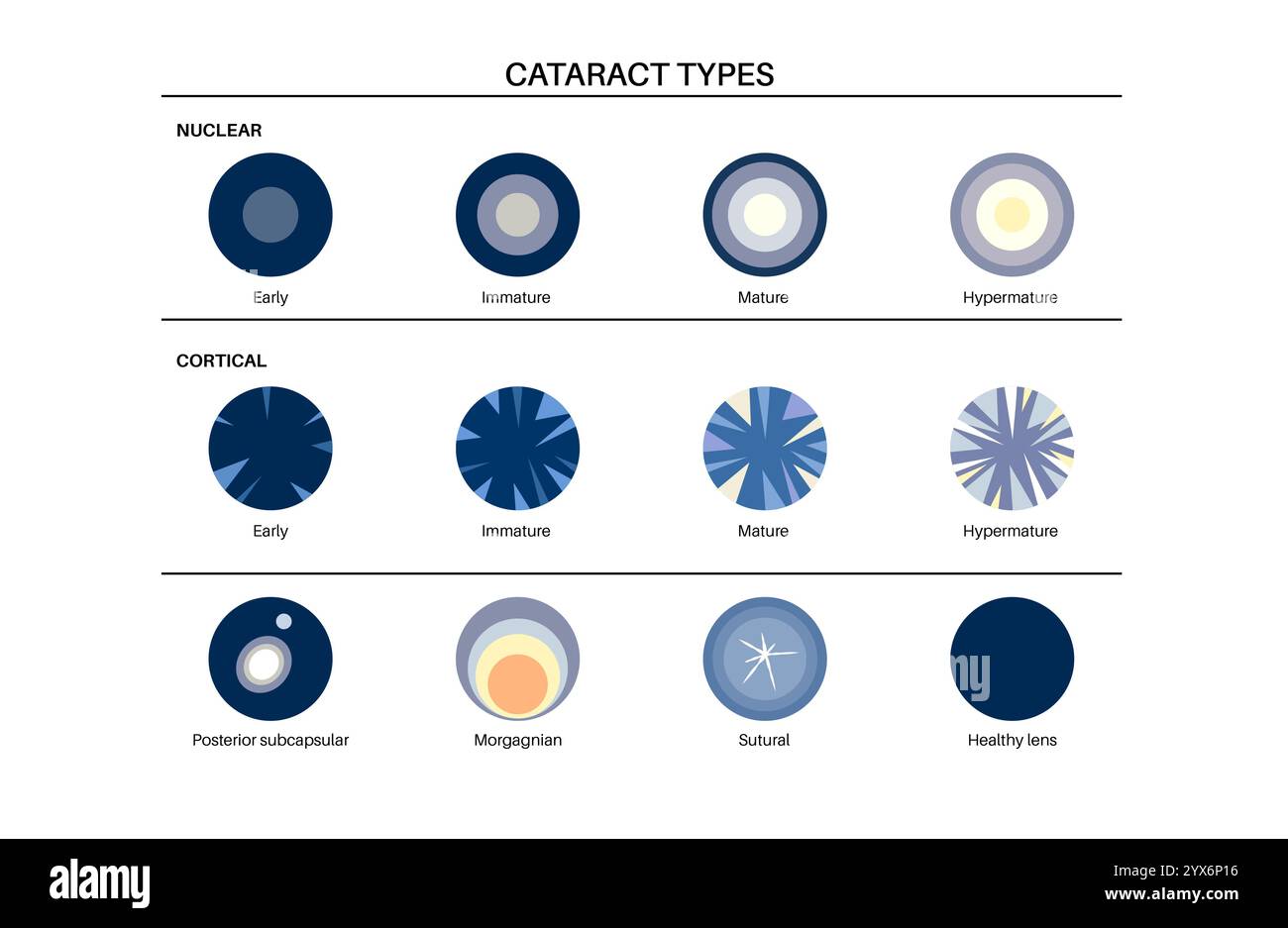 Cataract eye disease, illustration Stock Photo - Alamy