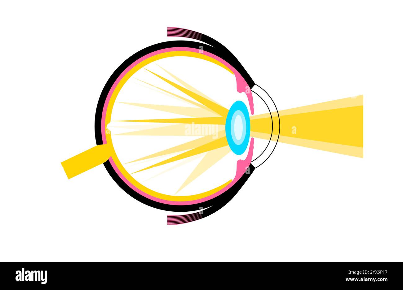 Cataract eye disease, illustration Stock Photo - Alamy