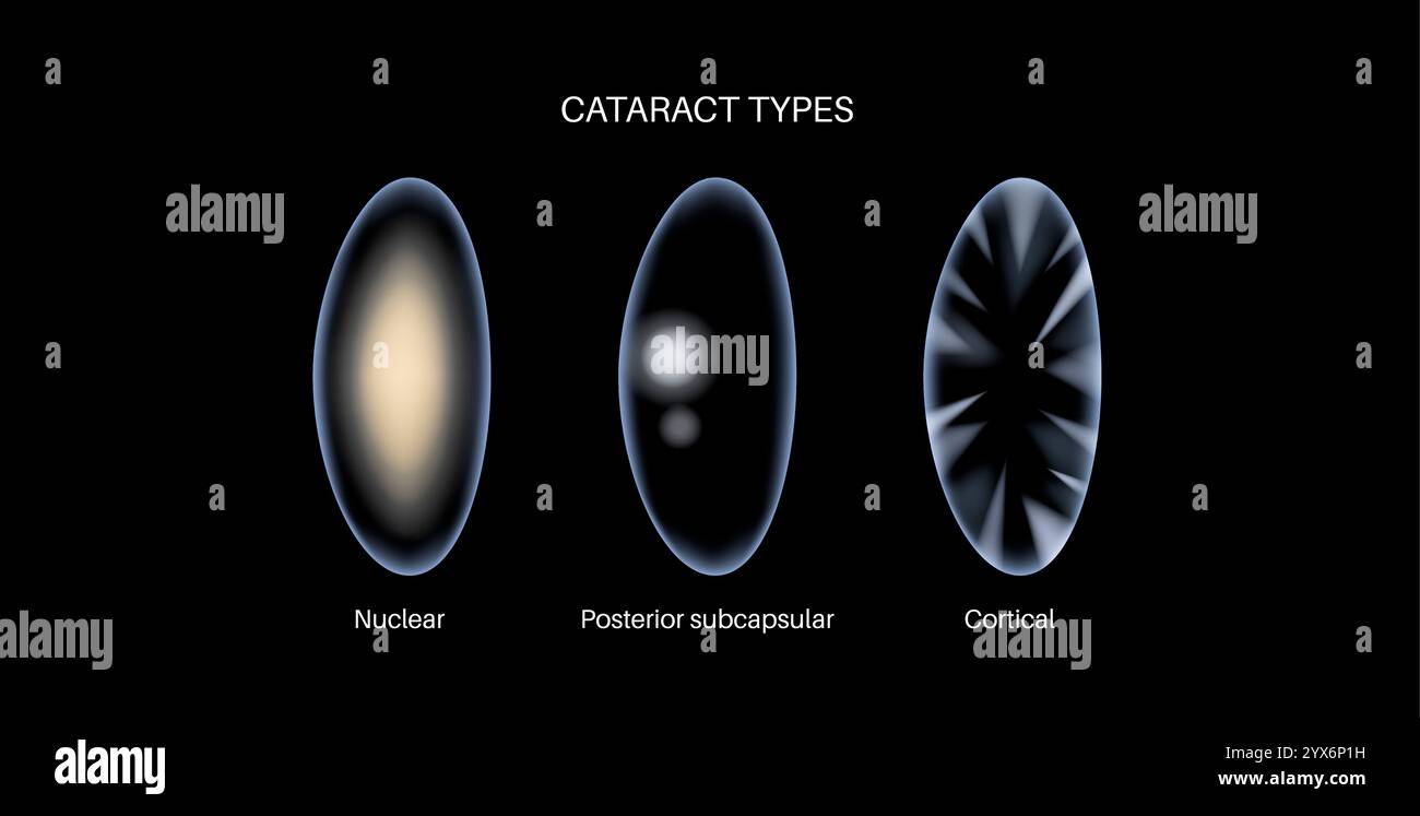 Cataract eye disease, illustration Stock Photo - Alamy