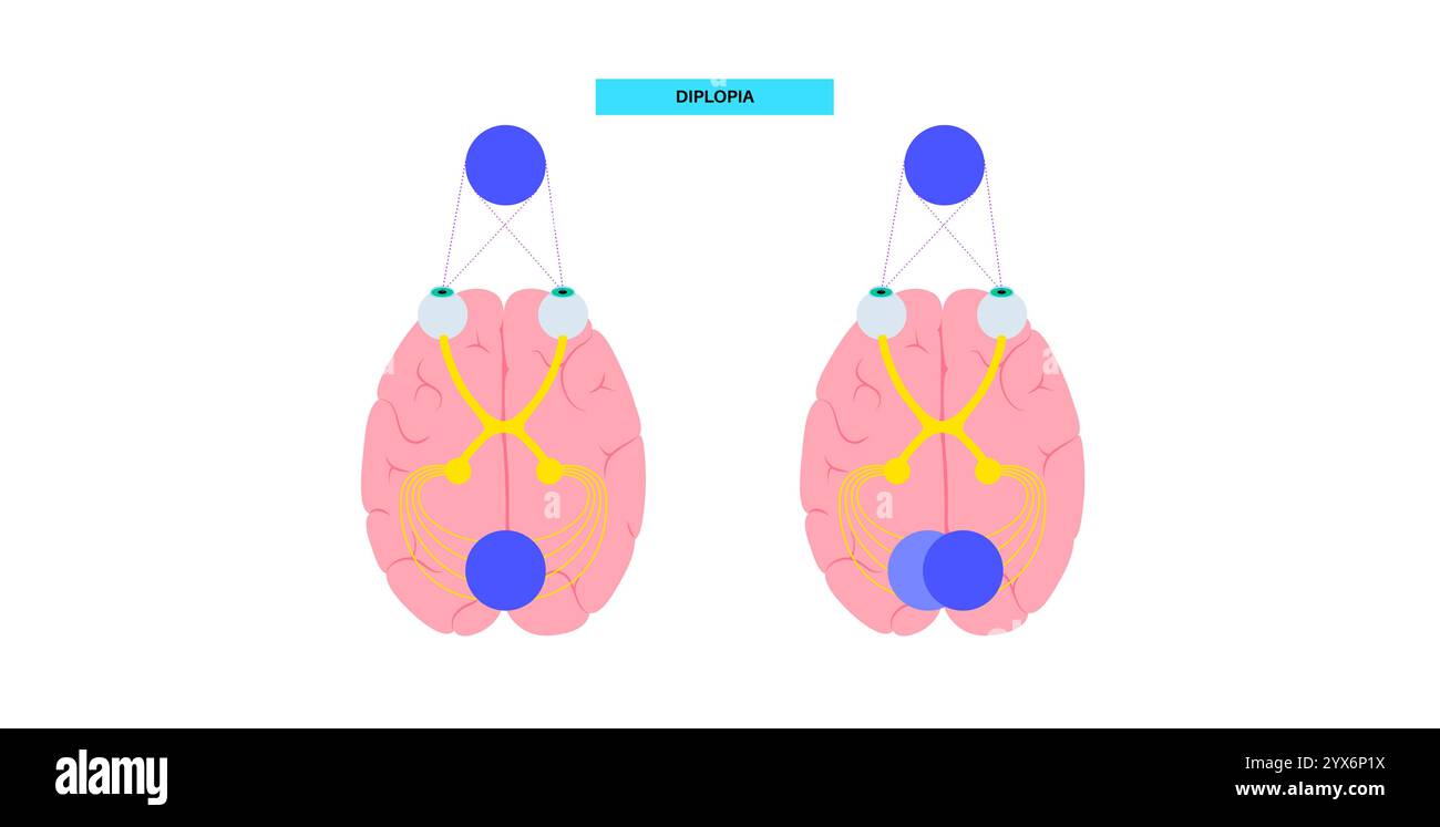 Double vision (diplopia), illustration Stock Photo - Alamy