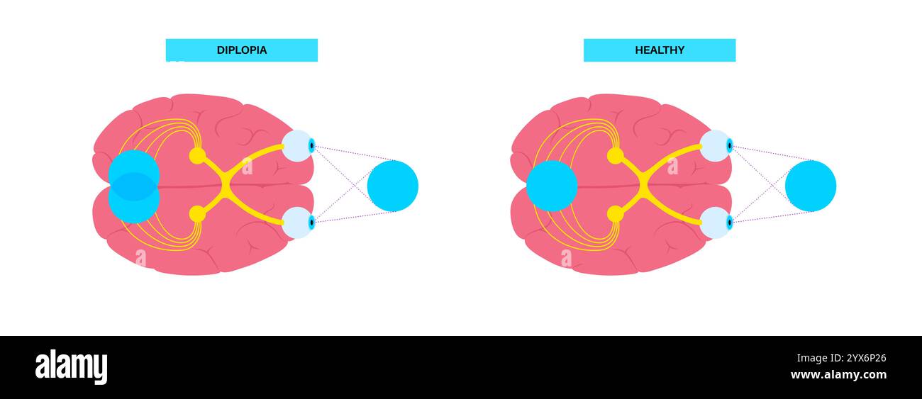 Double vision (diplopia), illustration Stock Photo - Alamy