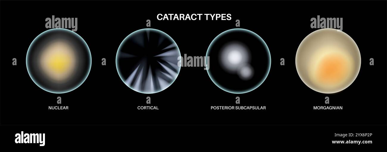 Cataract eye disease, illustration Stock Photo - Alamy