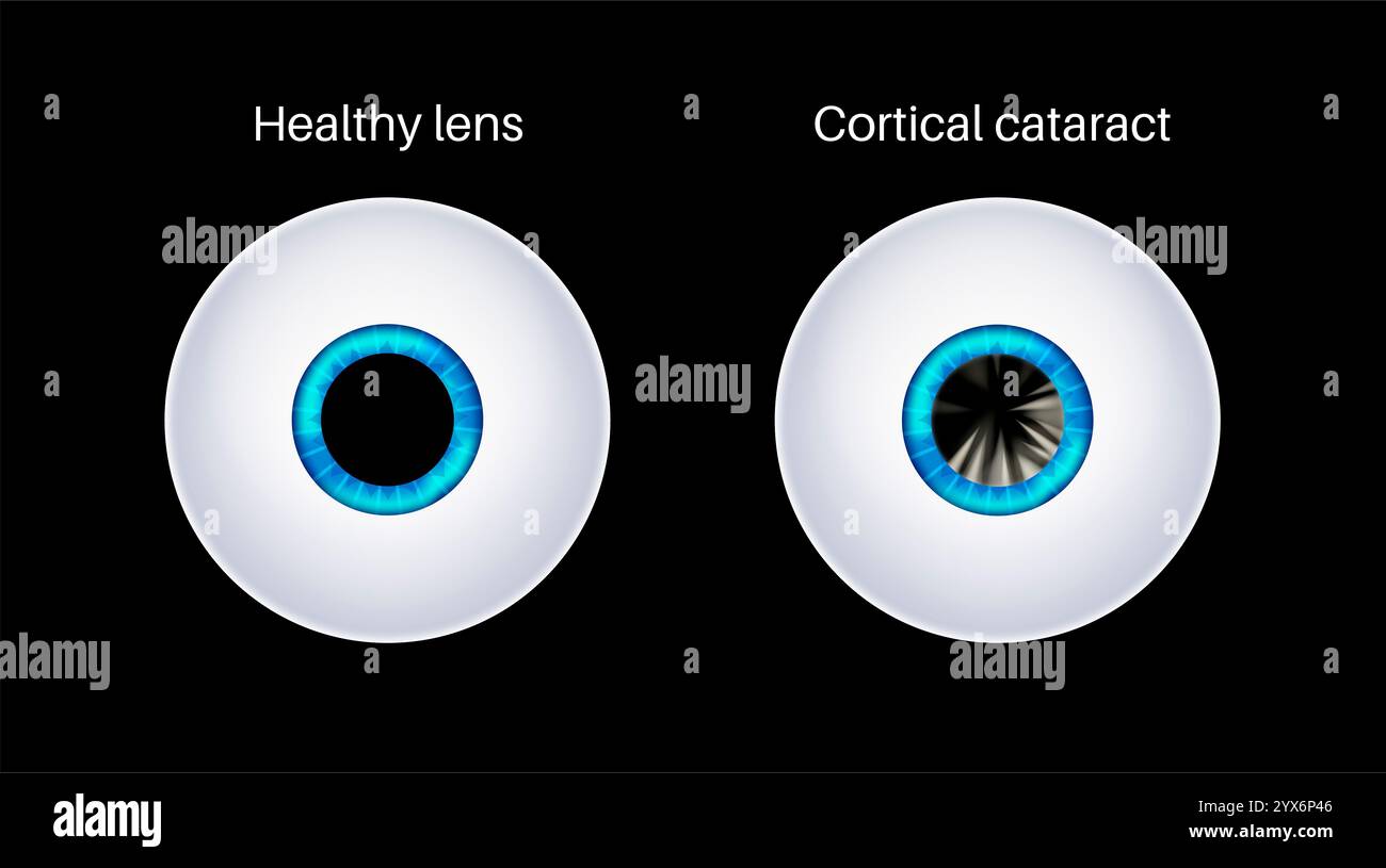 Cataract eye disease, illustration Stock Photo - Alamy