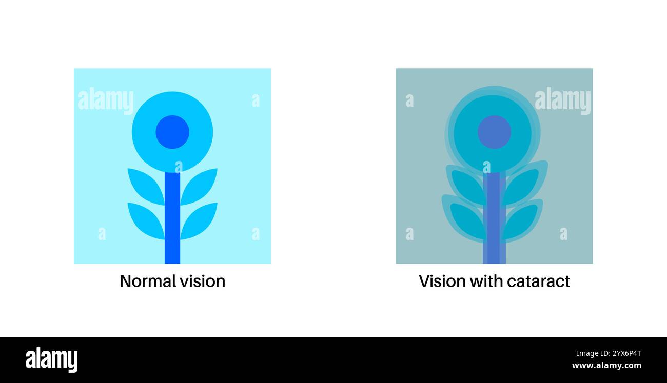 Cataract eye disease, illustration Stock Photo - Alamy