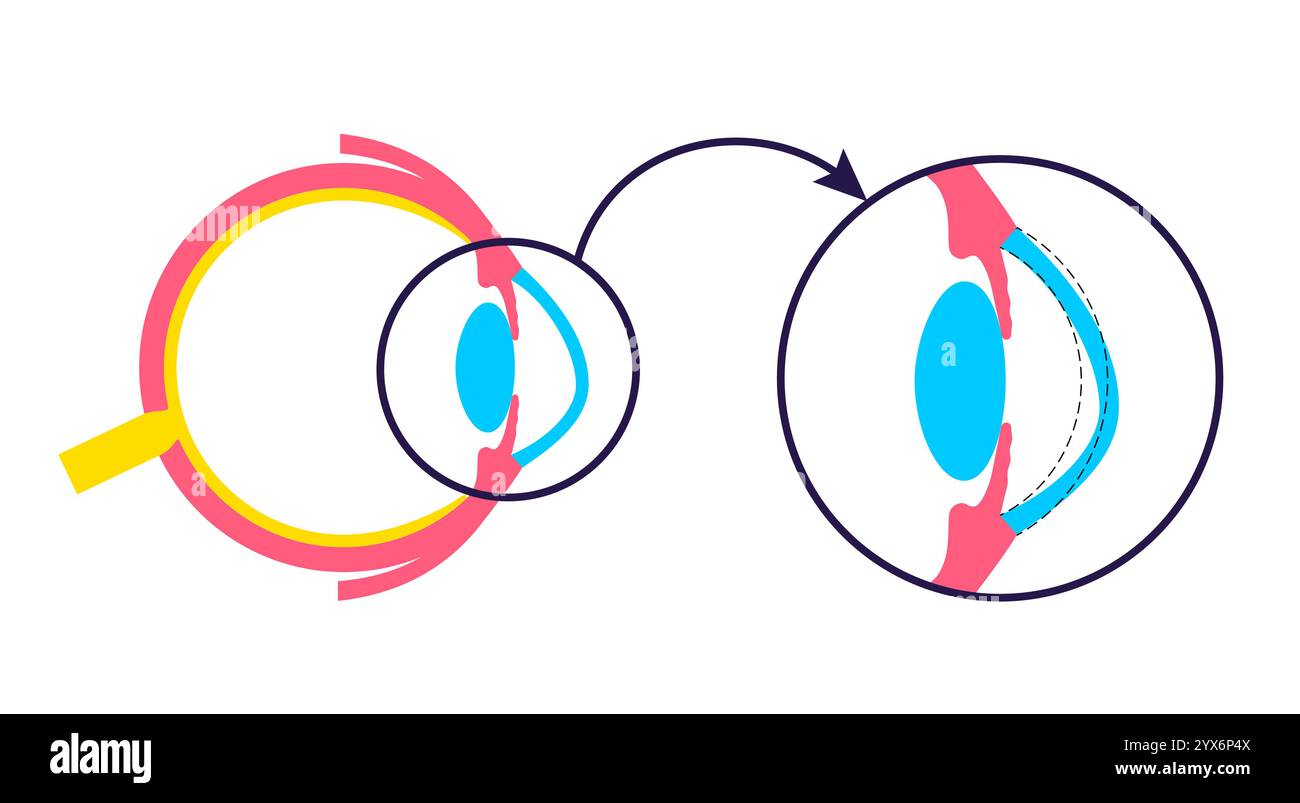 Cataract eye disease, illustration Stock Photo - Alamy