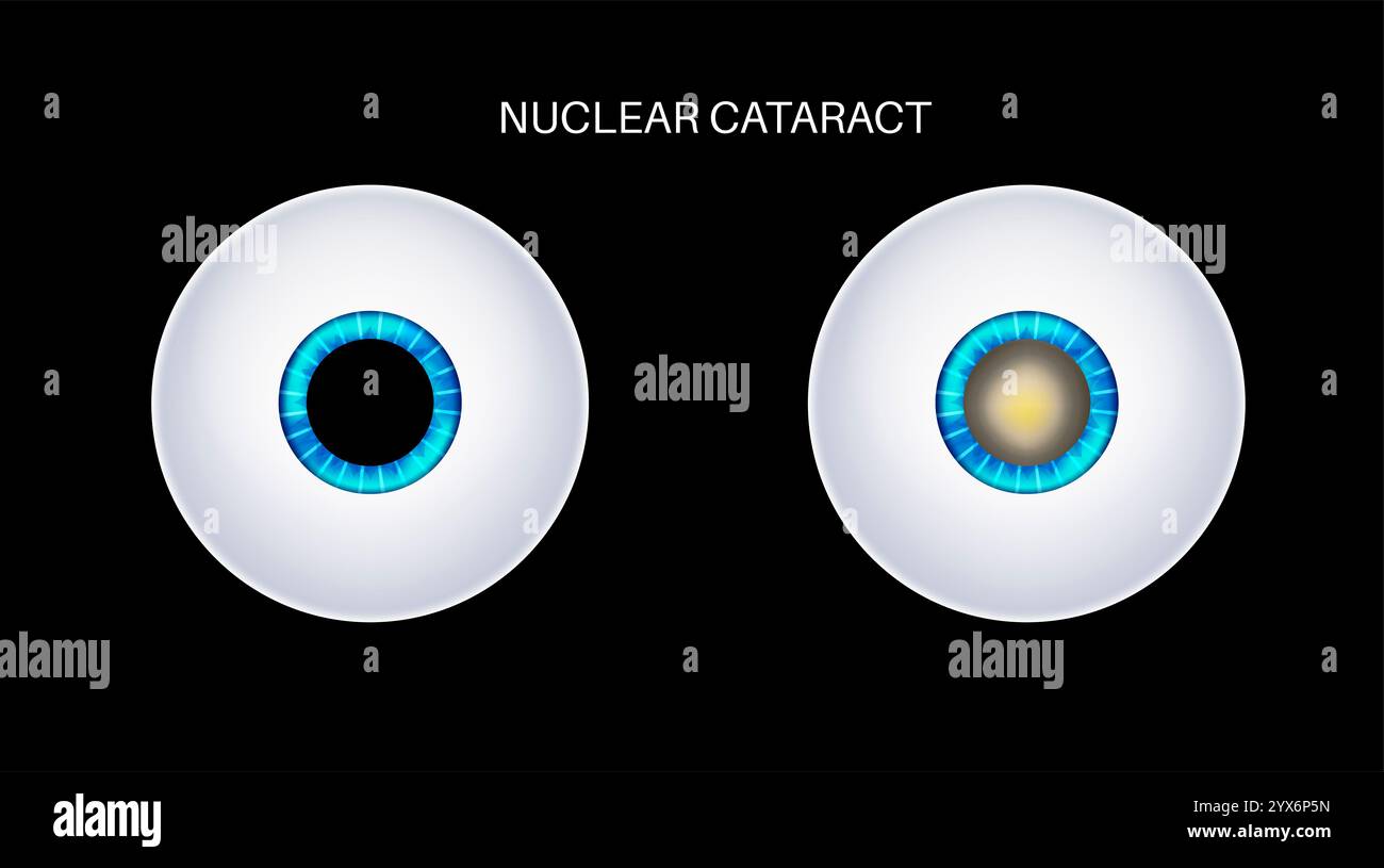 Cataract eye disease, illustration Stock Photo - Alamy